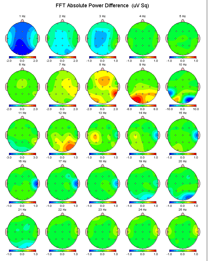 Quantitative Eeg Brain Mapping